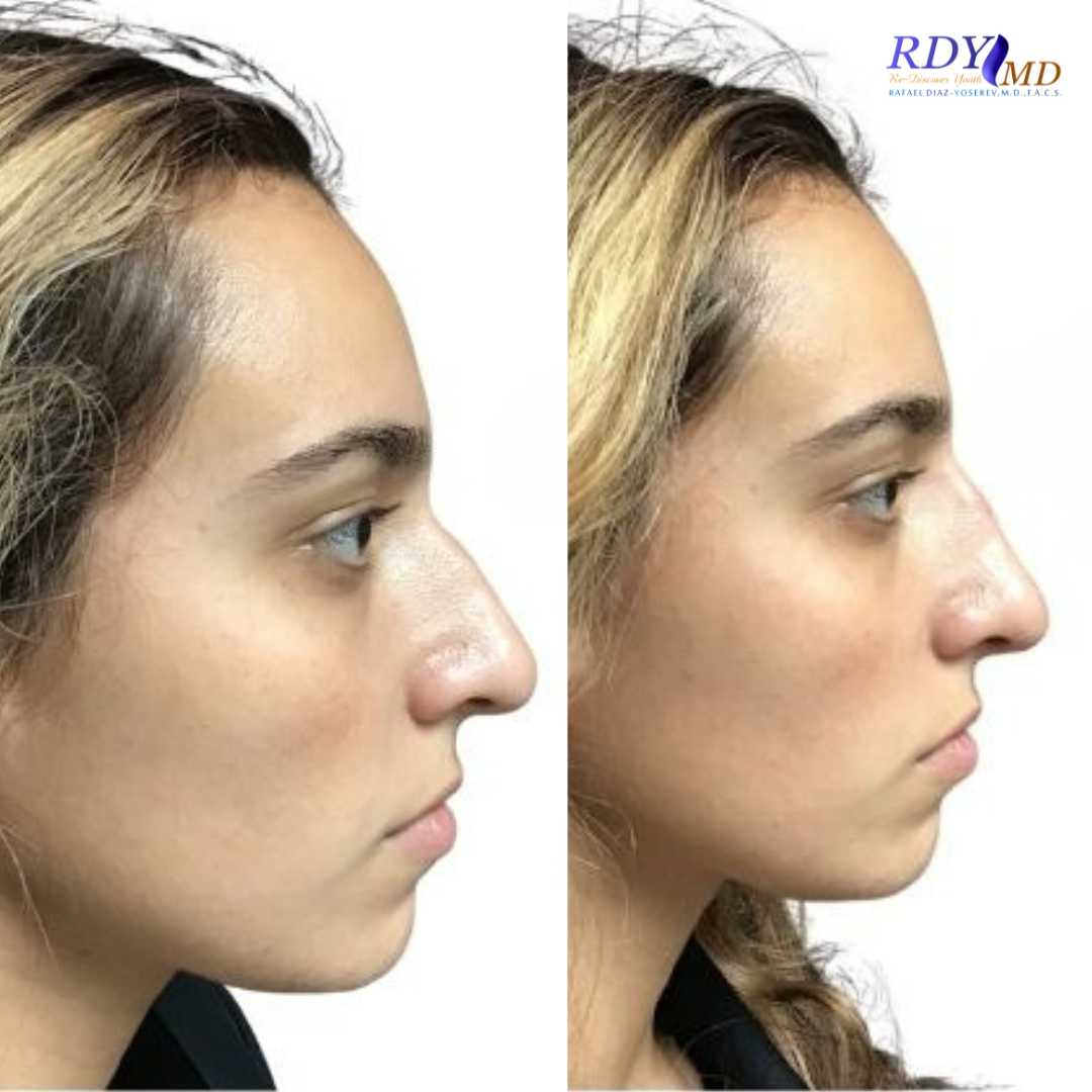 Procedure Template - Cosmetic Procedures | Miami | Coral Gables | RDYMD